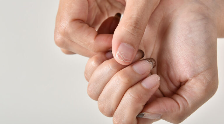 What Causes Discolored Nails and How to Treat Them? - HealthKart