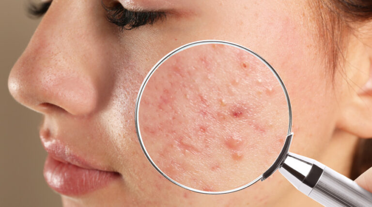 Stages of Acne: All You Need to Know - HealthKart