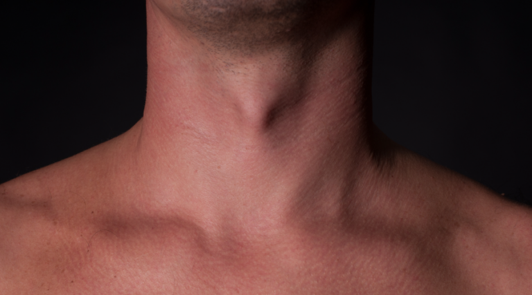 Adam's Apple: Is It Just the Men Who Have It? - HealthKart