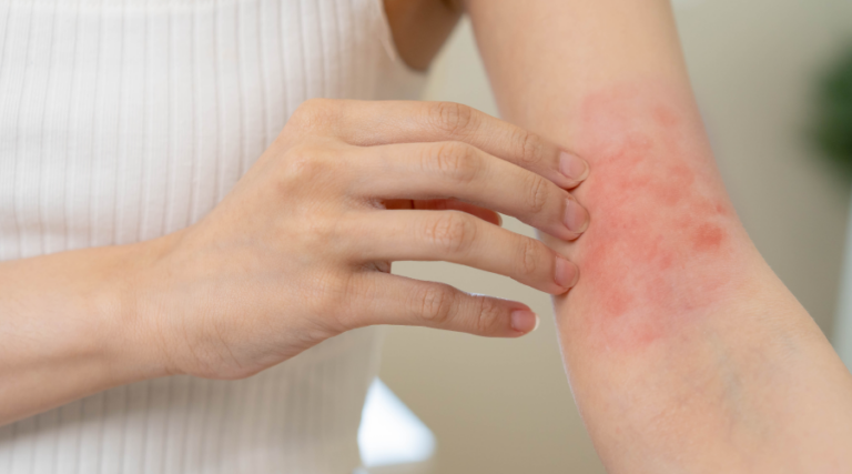 Types of Rashes: Do You Know About Any of Them? - HealthKart