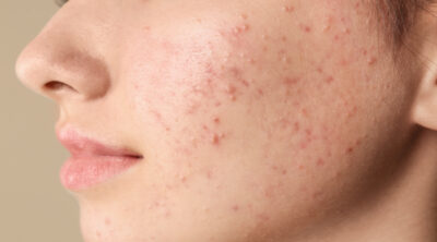 How To Remove Pimple Marks: Easy Home Remedies - HealthKart