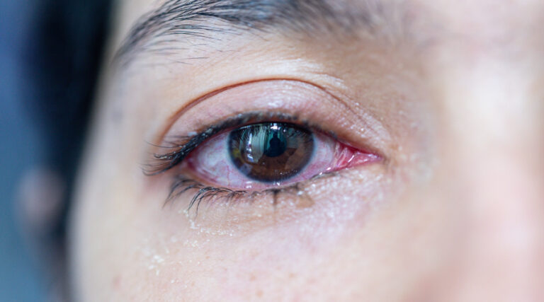 Watery Eyes: Causes, Symptoms, and Remedies - HealthKart