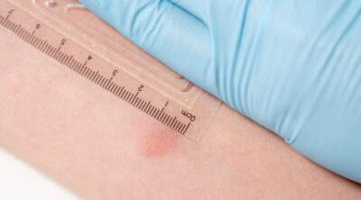 Skin Tuberculosis: Causes, Symptoms, and Treatment- Healthkart