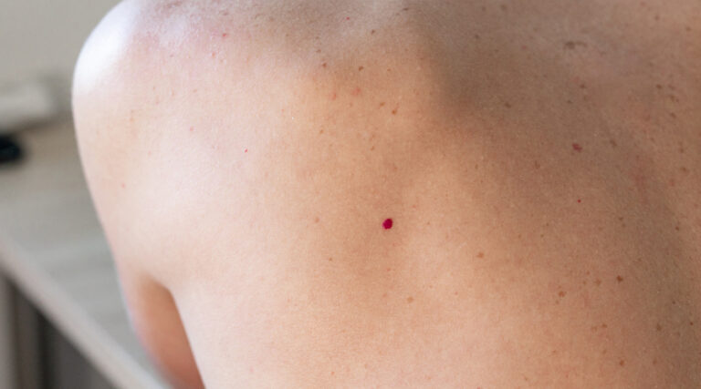 Cherry Angioma: What is It and What to Do? - HealthKart