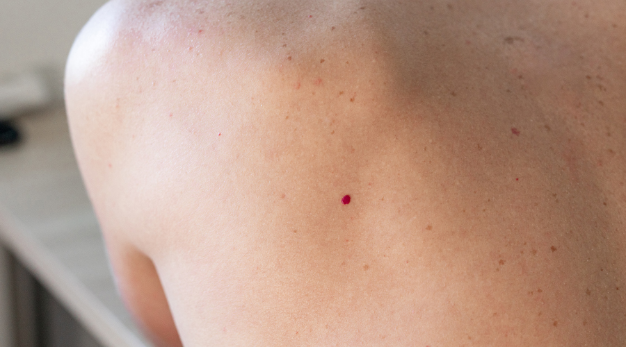 Cherry Angioma: What is It and What to Do? - HealthKart