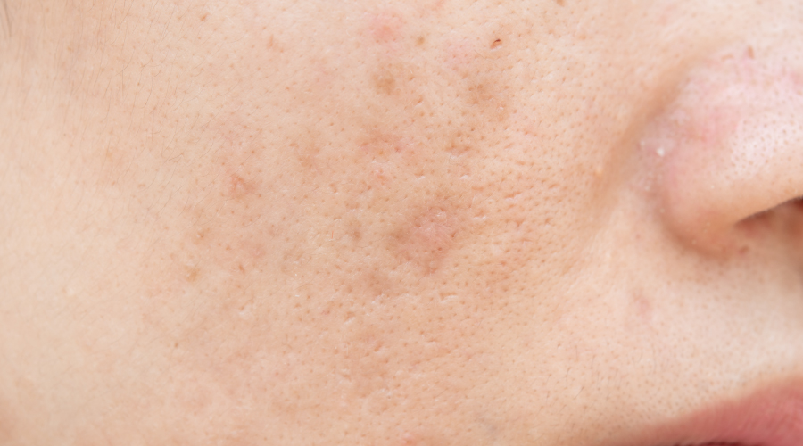 Dark Spots On Face Common Causes And Remedies HealthKart