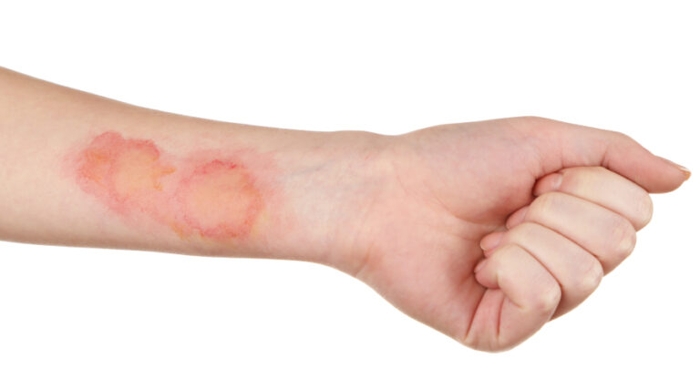 Skin Infection: Here's Everything You Need to Know - HealthKart