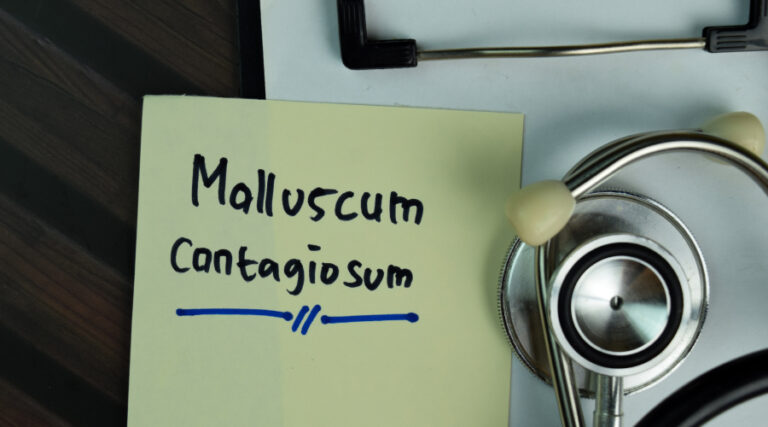 Molluscum Contagiosum: All You Need to Know - HealthKart