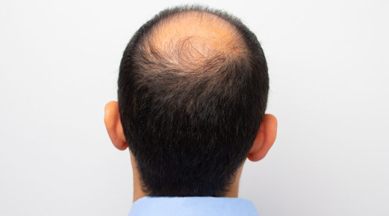 Understanding Your Type of Hairline And Hacks