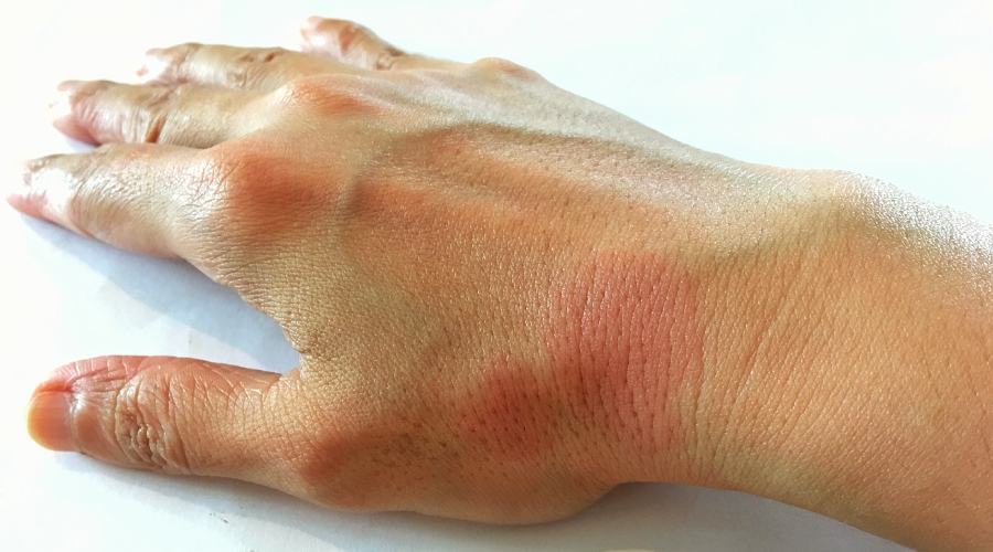 Lupus: Know Its Symptoms and Possible Causes - HealthKart