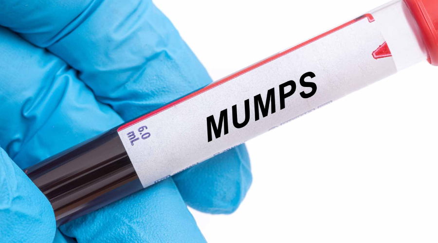 Mumps: Symptoms, Diagnosis, and How to Treat It - HealthKart
